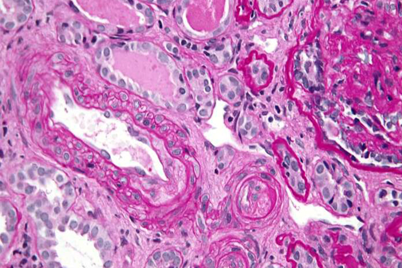 ¿Qué es la microangiopatía trombótica (TMA)? - BioQuimia Laboratorio